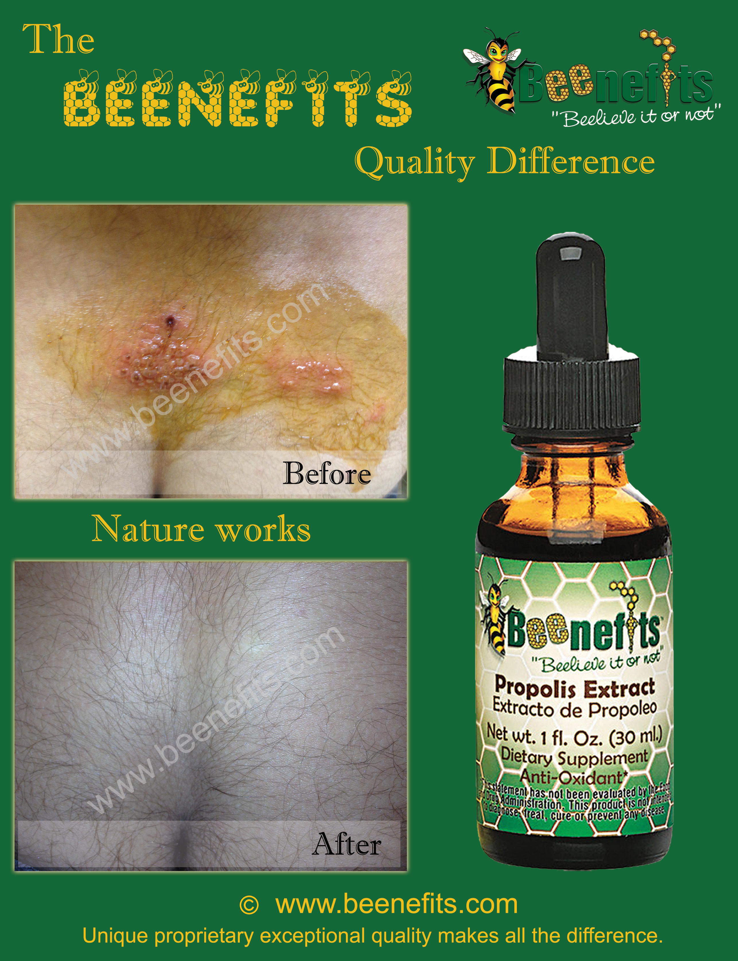 propolis and shingles | propolis mania